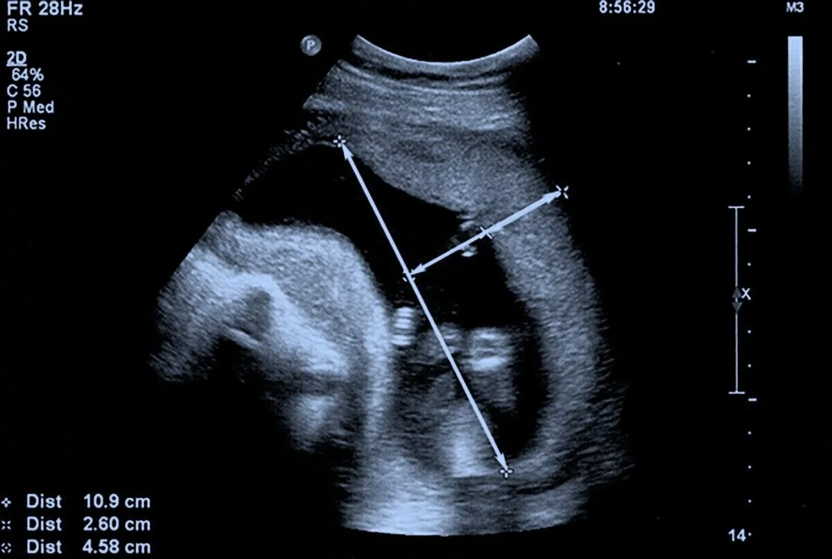 Measure the Placenta - Measure. Track. Prevent.