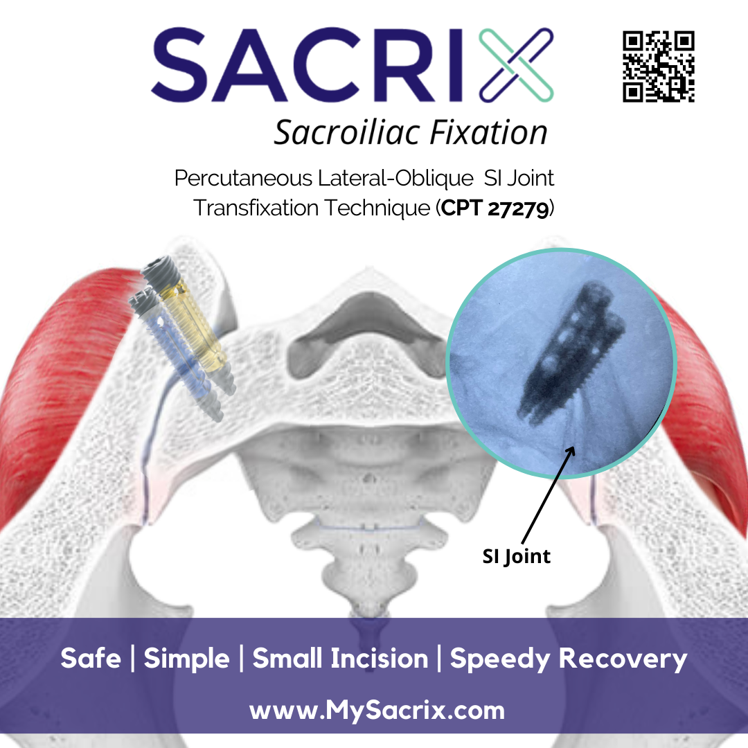 Sacrix - Stop SI Joint Pain