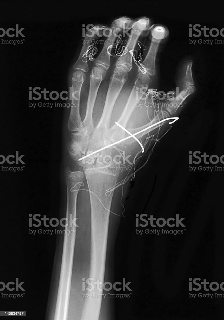 Hands / Wrists | Tendon Lacerations — Direct Orthopedic Care