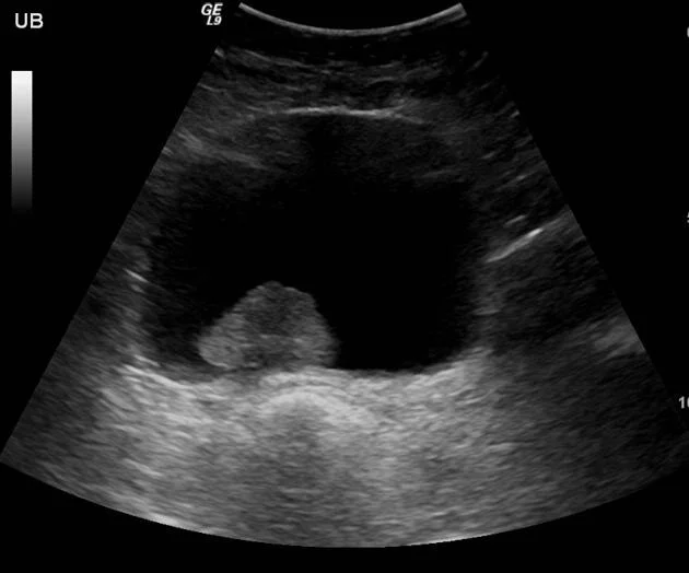 Bladder Cancer — Adelaide Urology Care