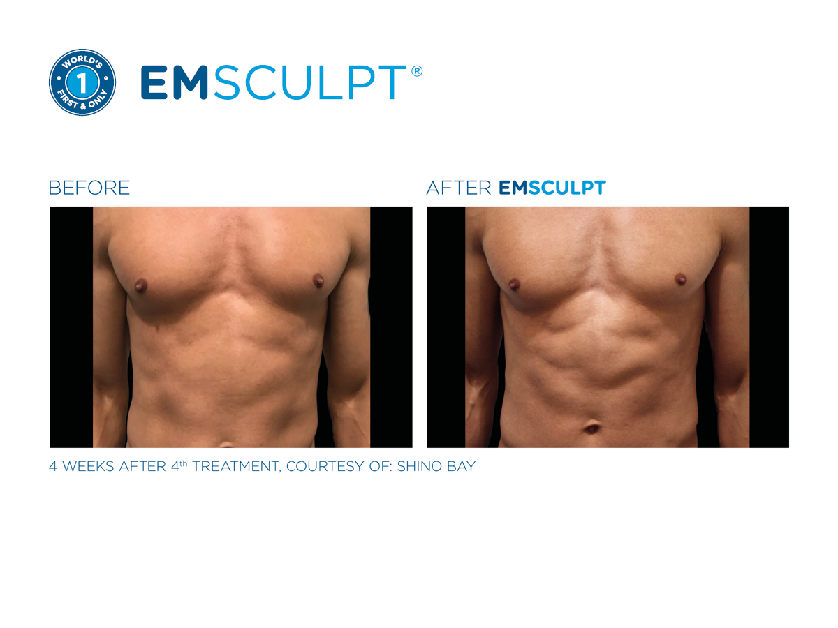 EMSCULPT Burn Fat + Tone Muscle — Lawson Aesthetics & Med Spa