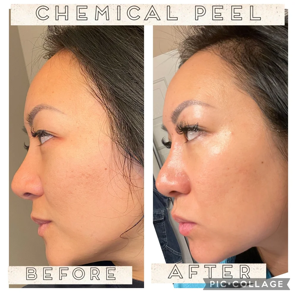 Chemical Peels Before And After Women Of Color