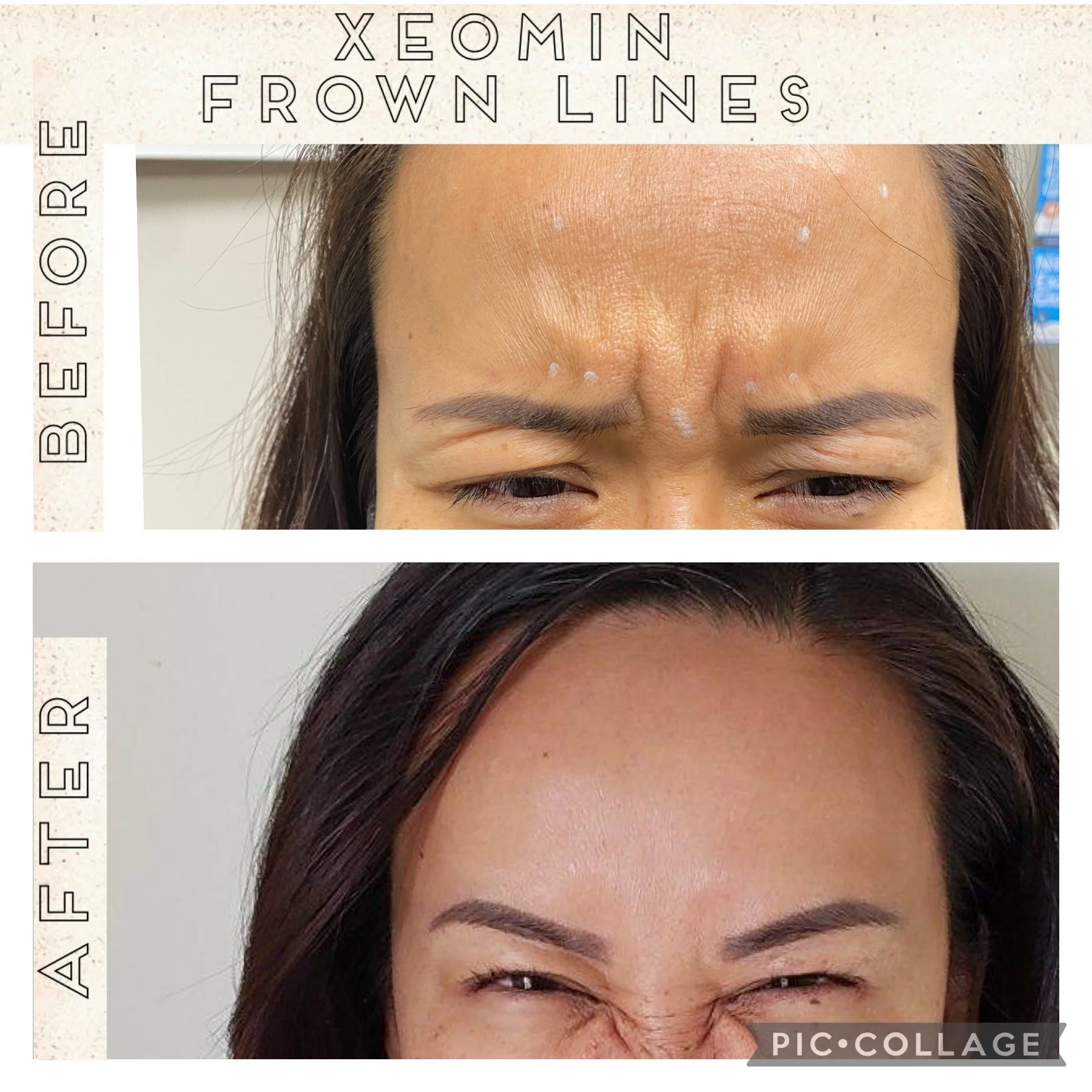 Anti-Wrinkle Treatment — Sculpted Aesthetics By Dr. Michelle Le