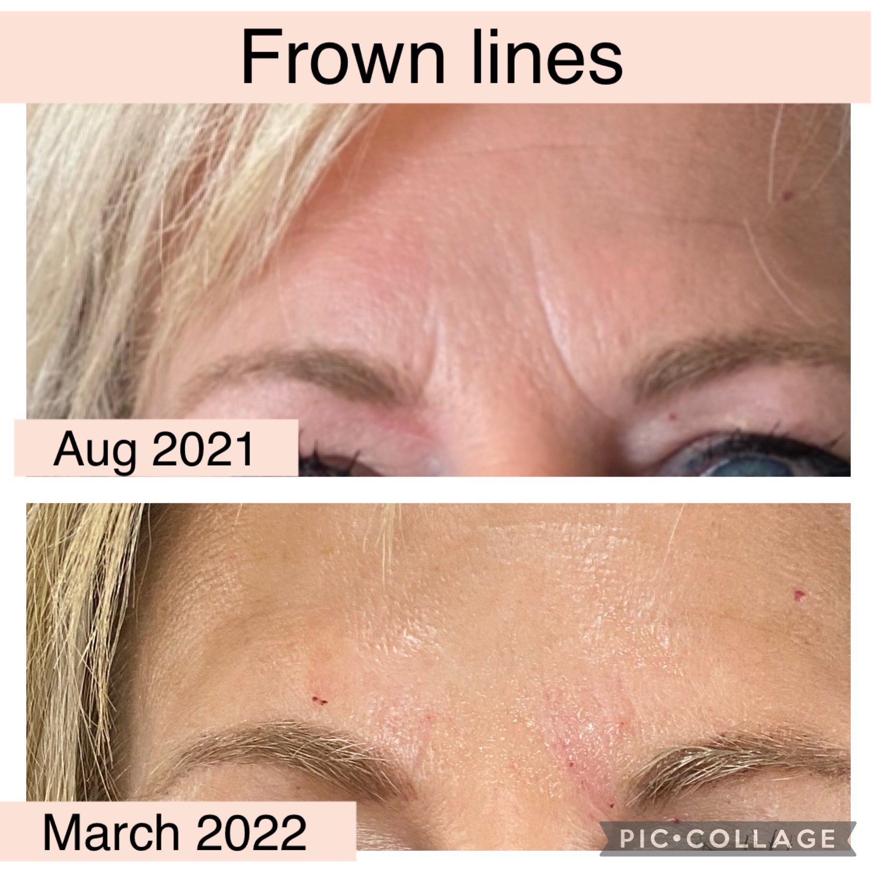 Anti-Wrinkle Treatment — Sculpted Aesthetics By Dr. Michelle Le