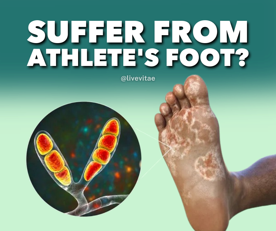 Athletes' Foot: Causes, Natural Remedies & Prevention - Live Vitae