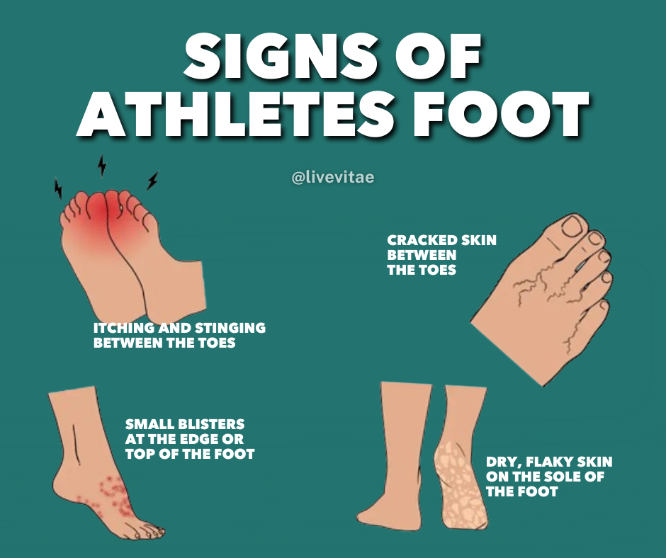Athletes' Foot: Causes, Natural Remedies & Prevention - Live Vitae