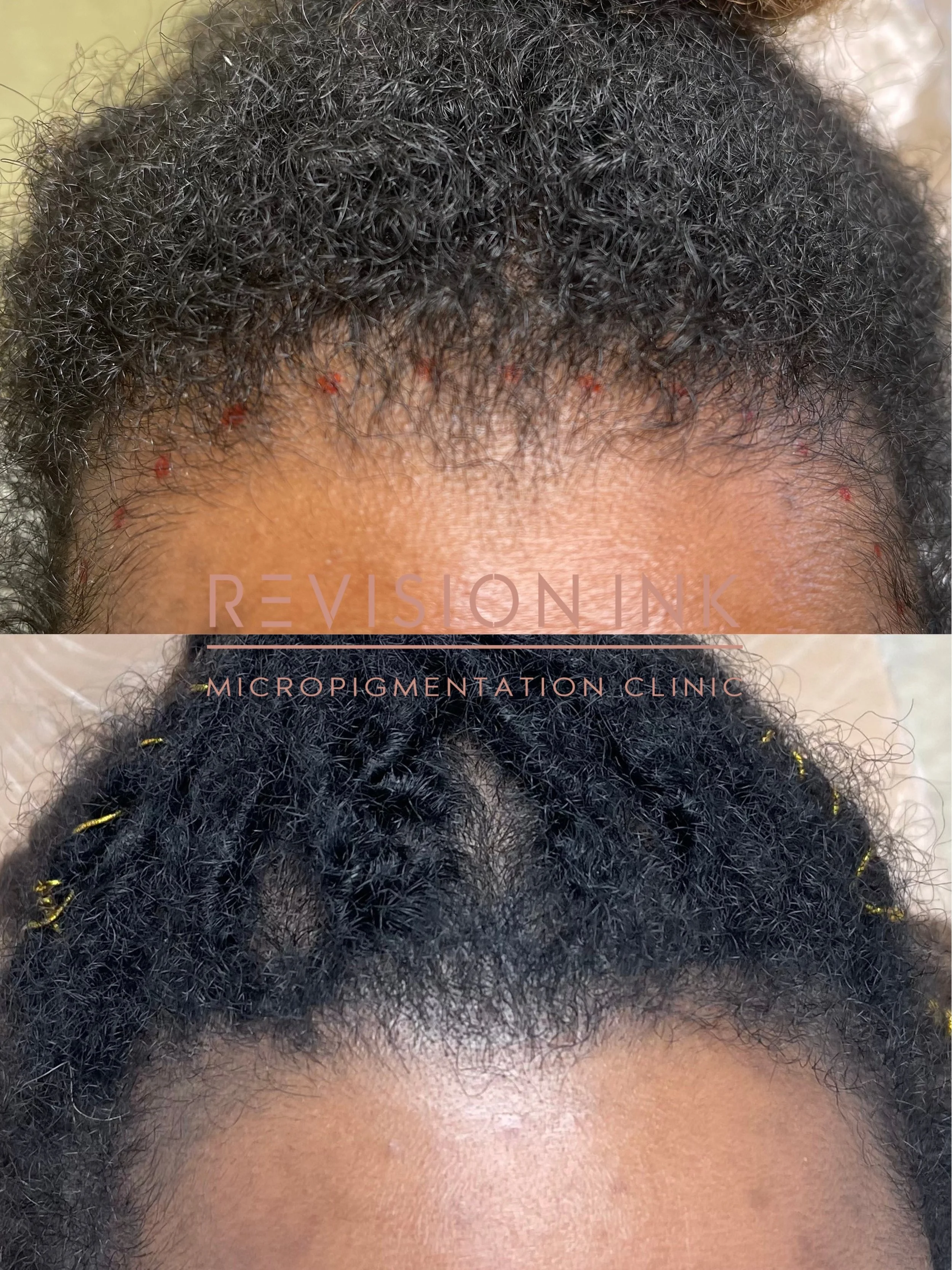 Scalp Micropigmentation in Lafayette, Louisiana - Revision Ink ...