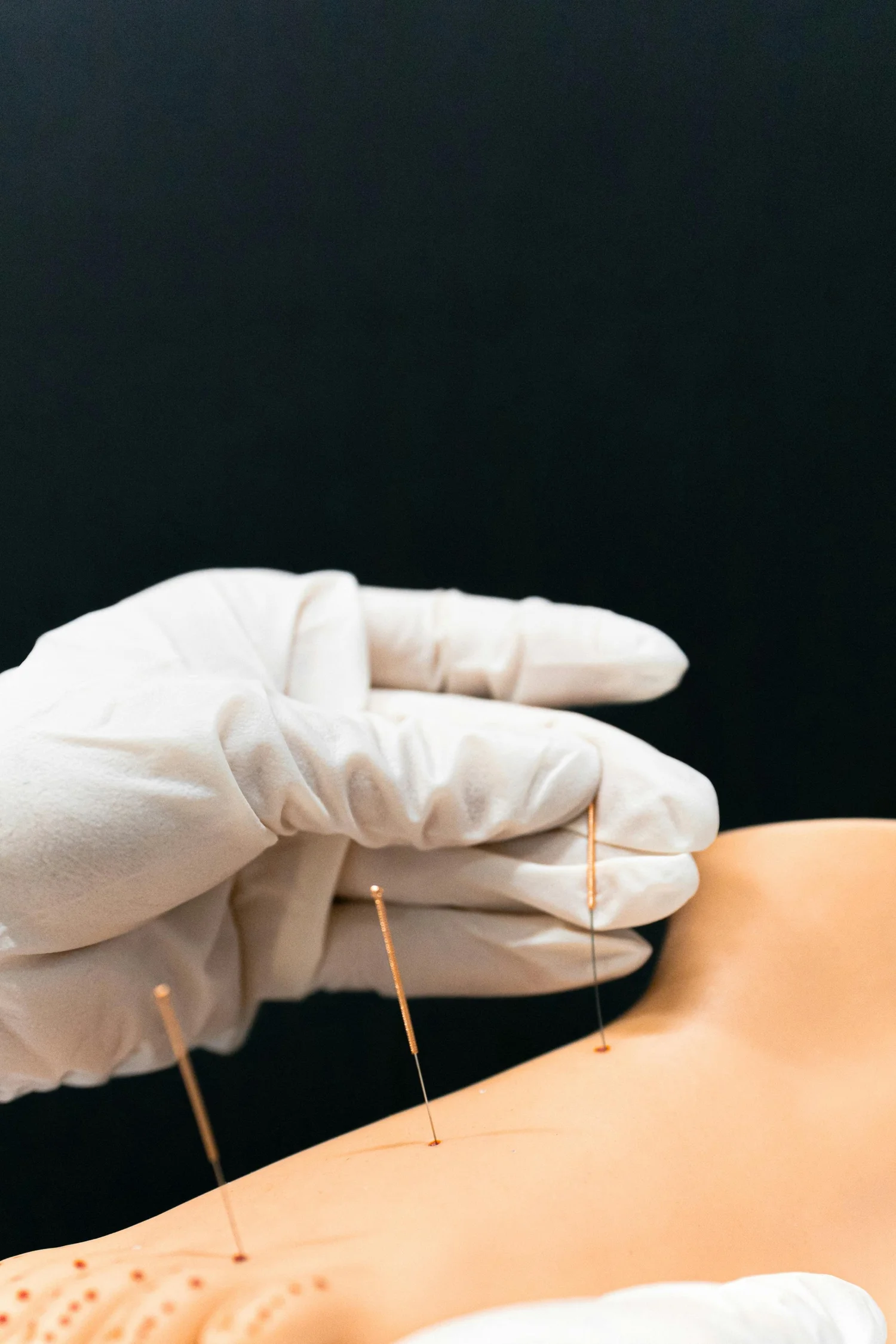 Acupuncture in Midtown Manhattan NYC | Integrative PT of NYC ...