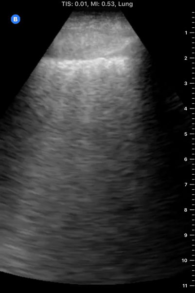 Lung Ultrasound — POCUS UK