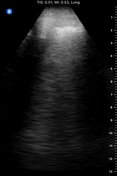 Lung Ultrasound — POCUS UK