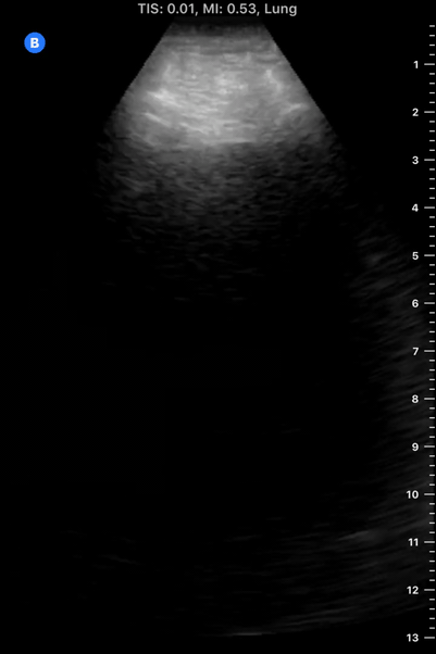 Lung Ultrasound — POCUS UK