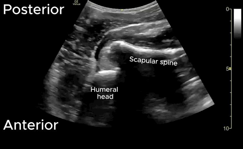 Sound Bite 16 - Anterior Shoulder Dislocation — POCUS UK