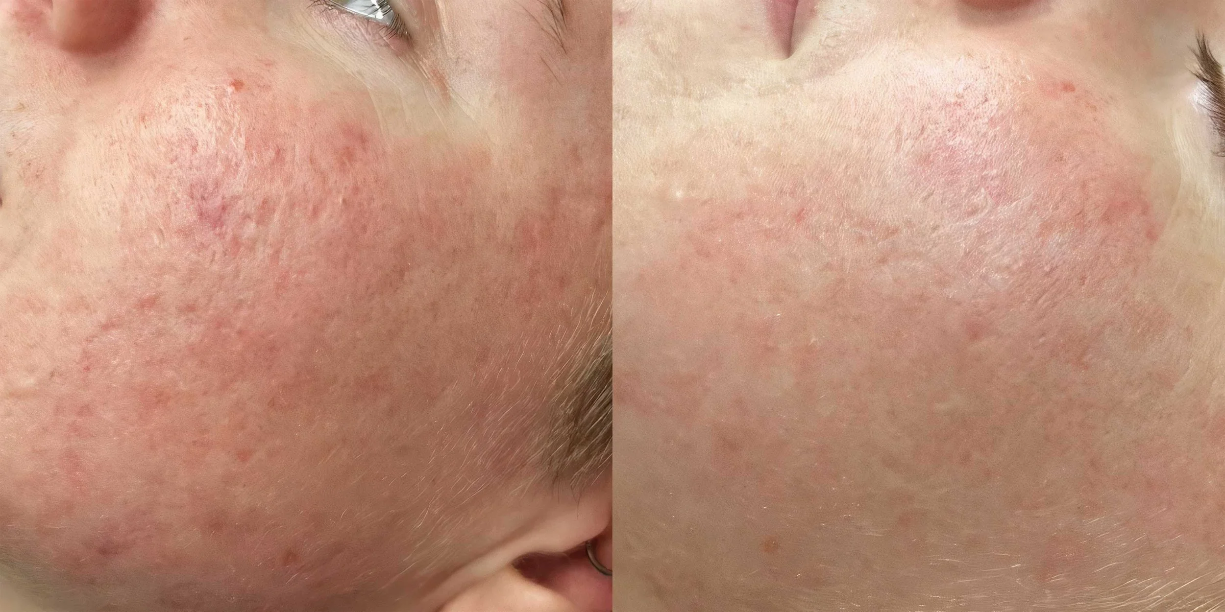EVOKE | FACIAL CONTOURING | Coastal757 Med Spa Virginia Beach