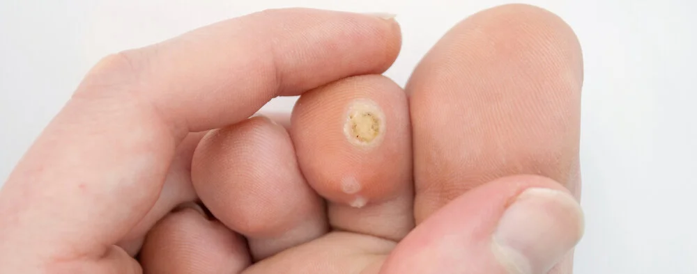 Verruca Treatments | Chiropodist & Podiatrist in Poole and Bournemouth ...
