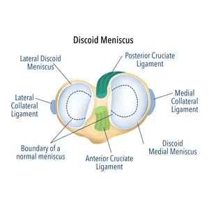 Discoid Meniscus Surgery | Discoid Meniscus Treatment