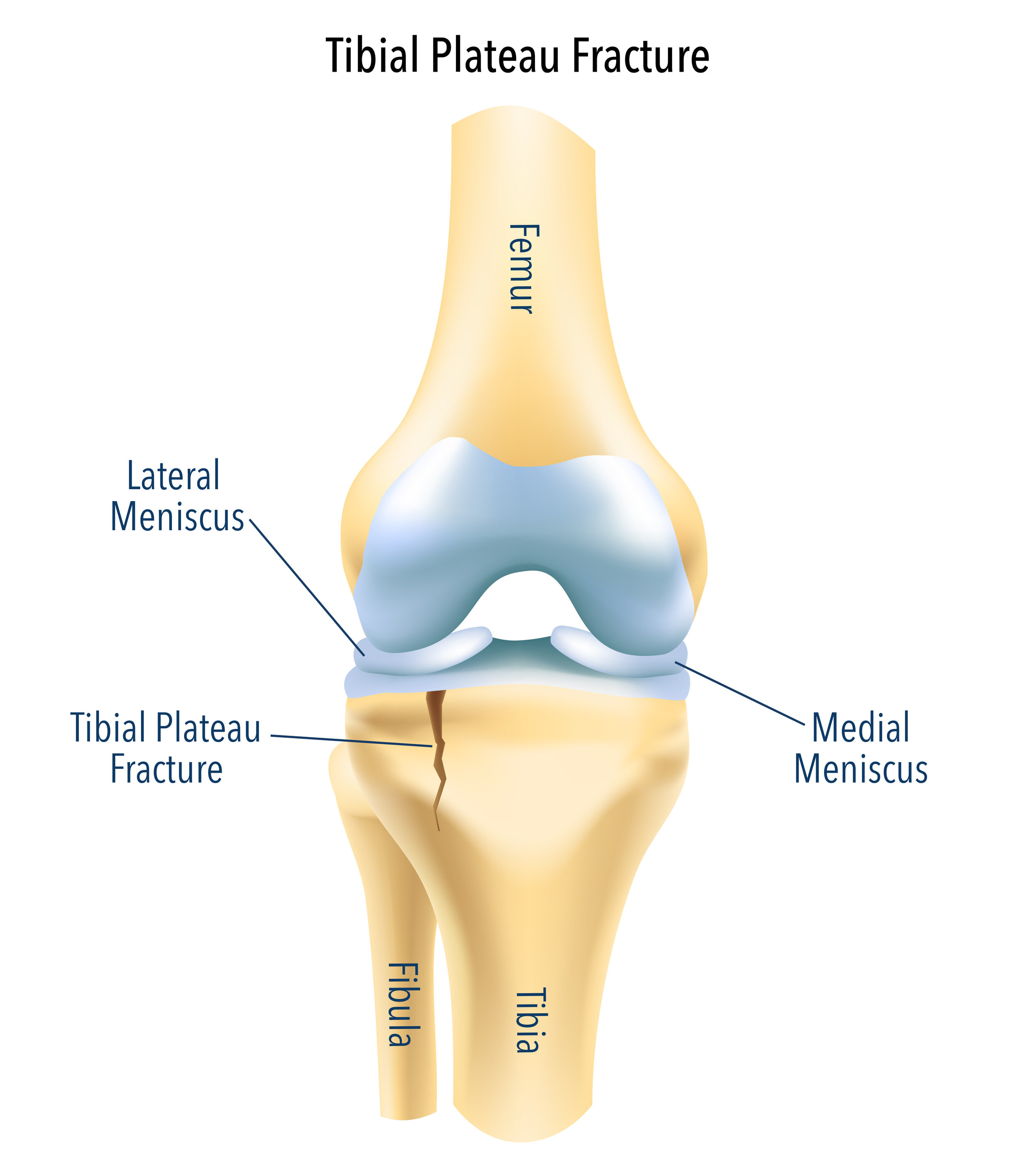 Tibial Plateau Fracture