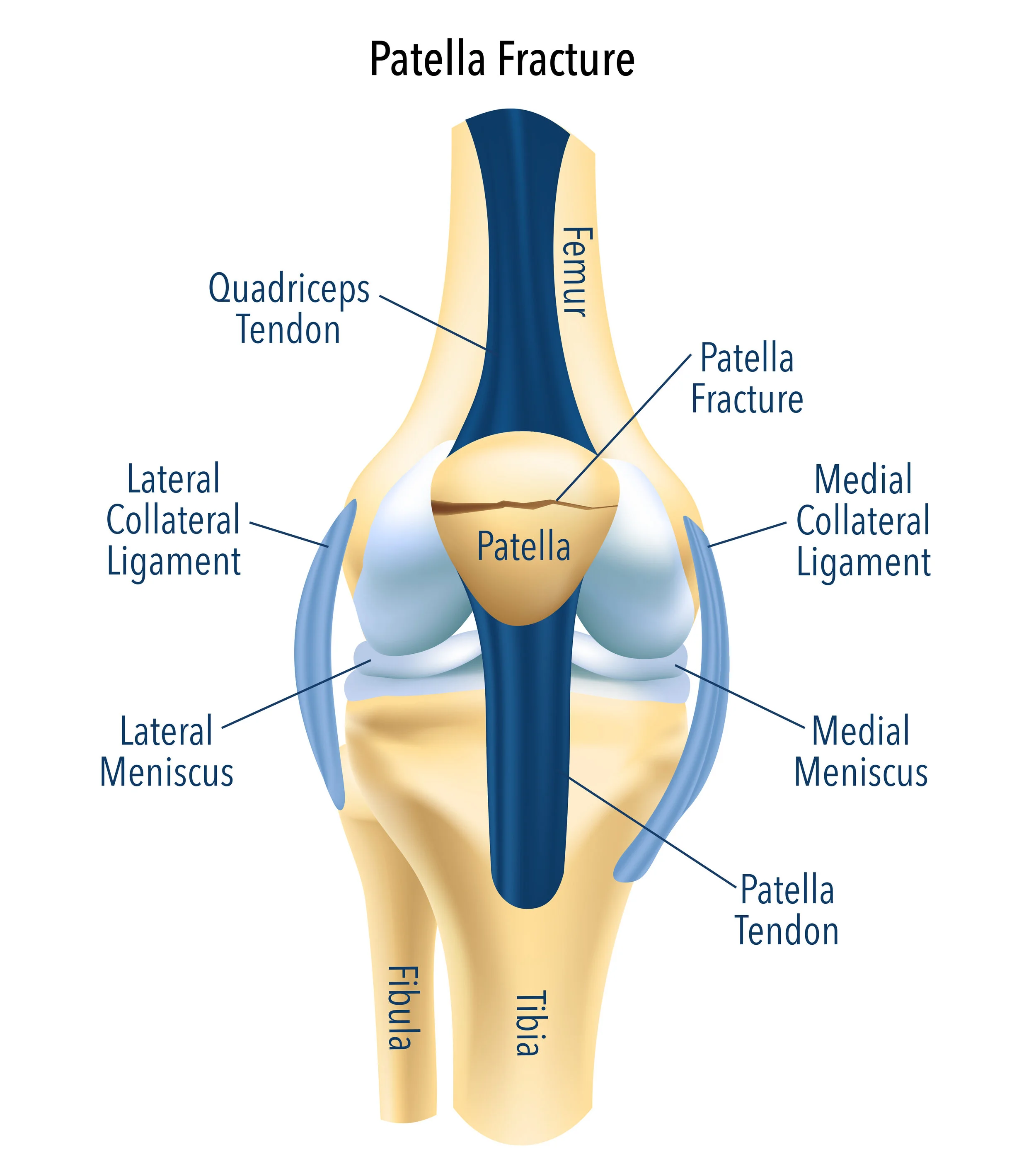 Fracture Patella Broken Knee