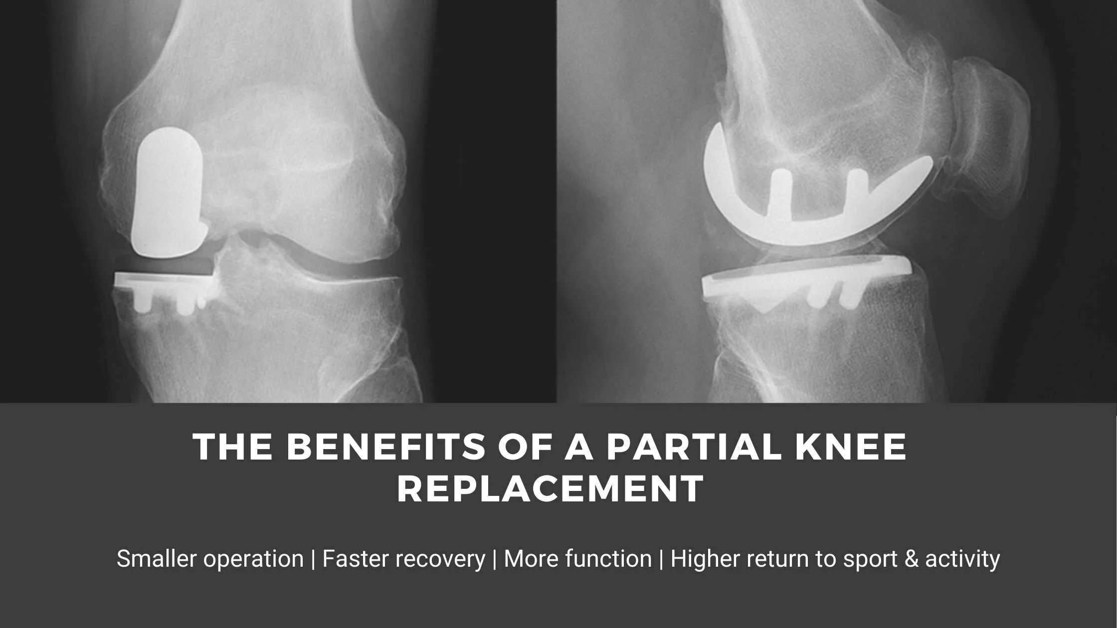 Partial Knee Replacement | Faster Recovery