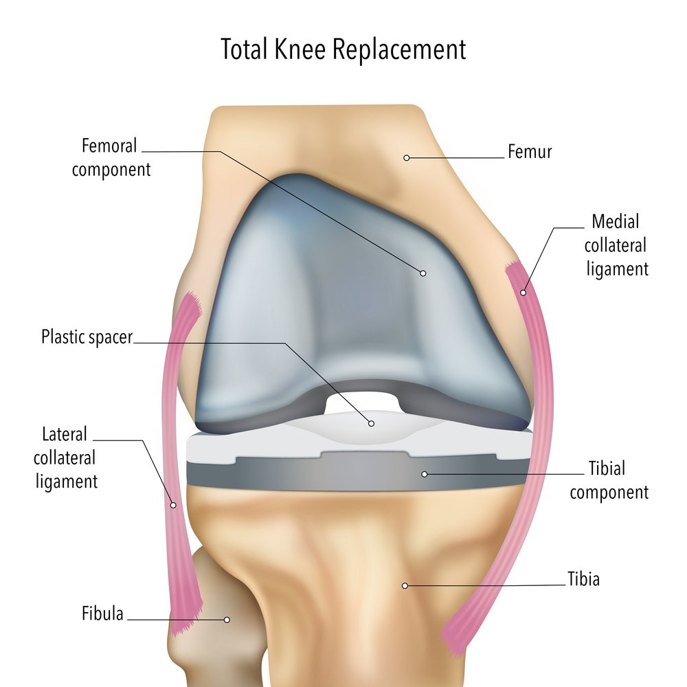 Knee Replacement Surgeon Melbourne | Knee Replacement Surgery