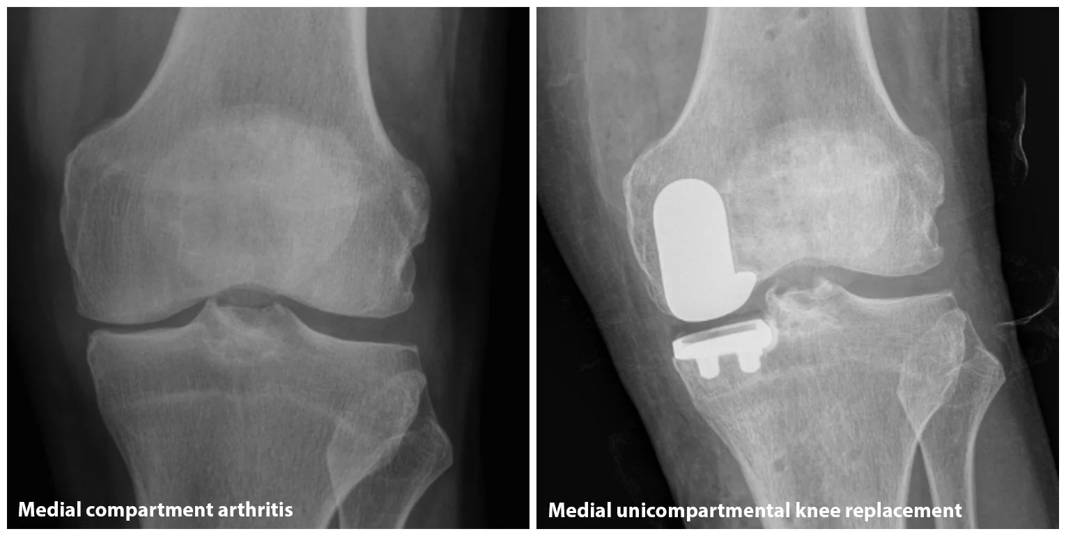 Partial Knee Replacement Surgery | Partial Knee Arthroplasty