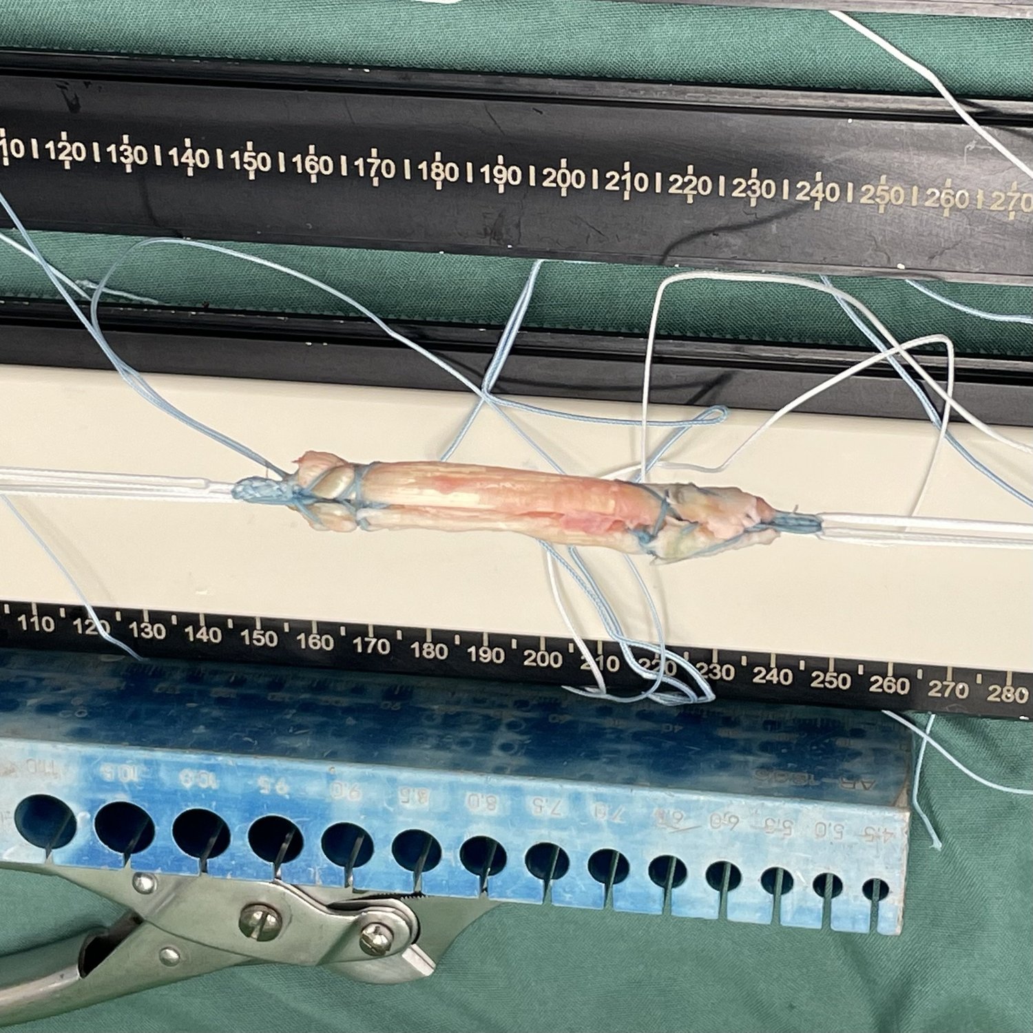 Quadriceps tendon graft in ACL reconstruction - News