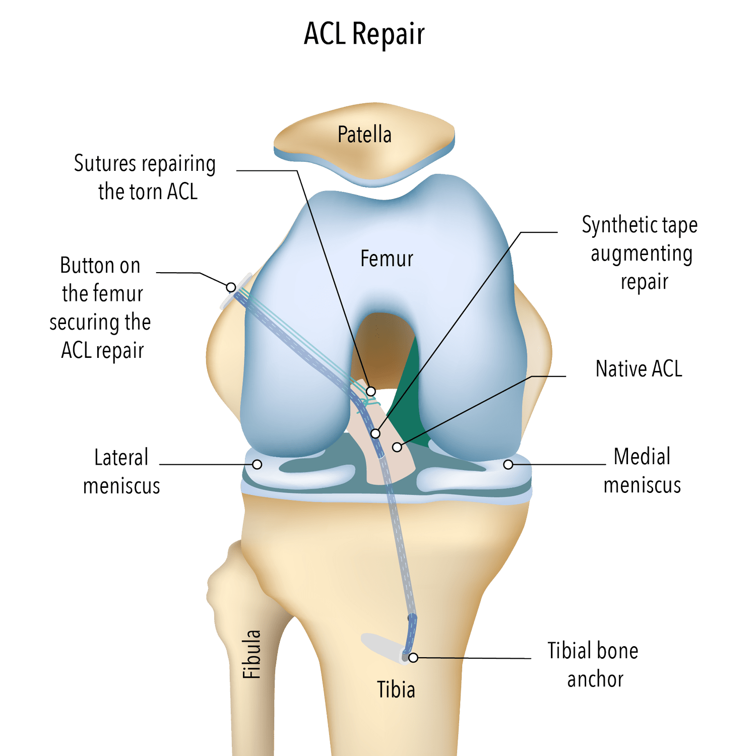 ACL Repair Surgery ACL Rupture ACL Tear Repair acl-repair-surgery-acl-rupture-acl-tear-repair