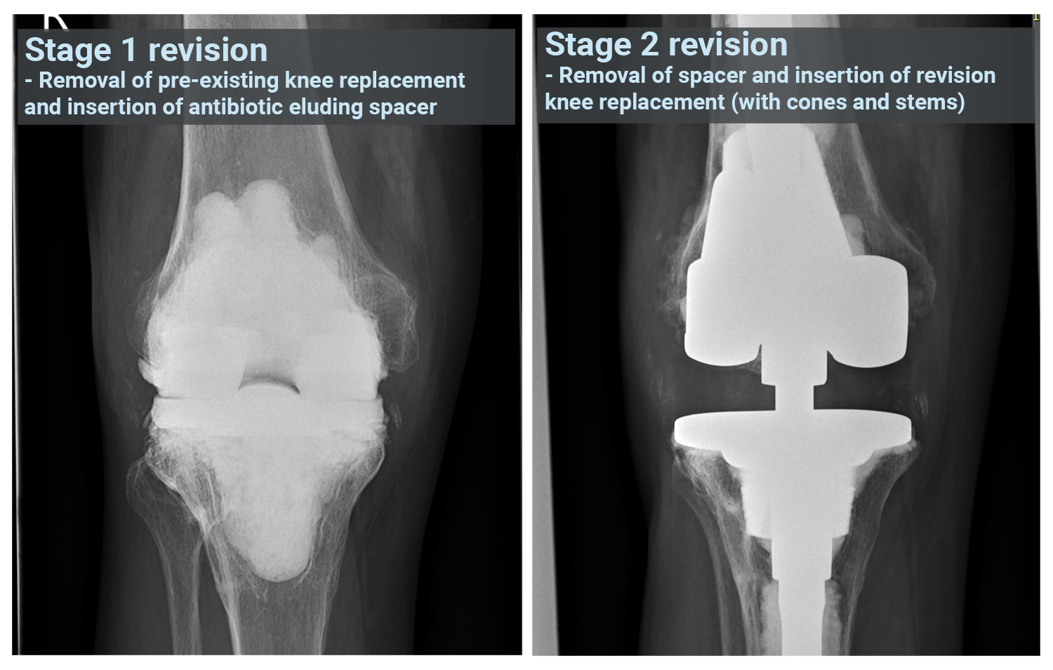 Revision Knee Replacement Surgery Revision Knee Replacement Surgery