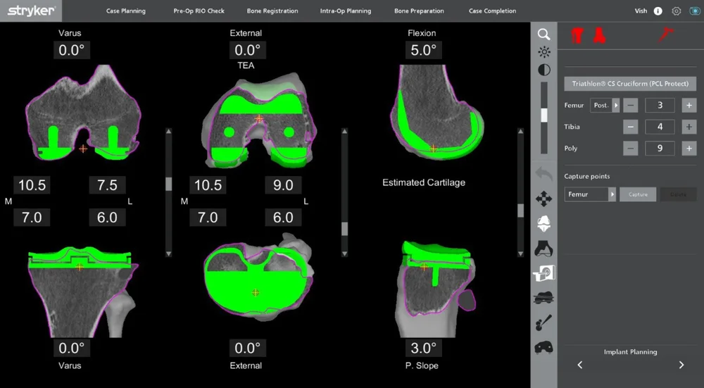 Robotic Partial Knee Replacement Surgery | Robotic Joint Replacement