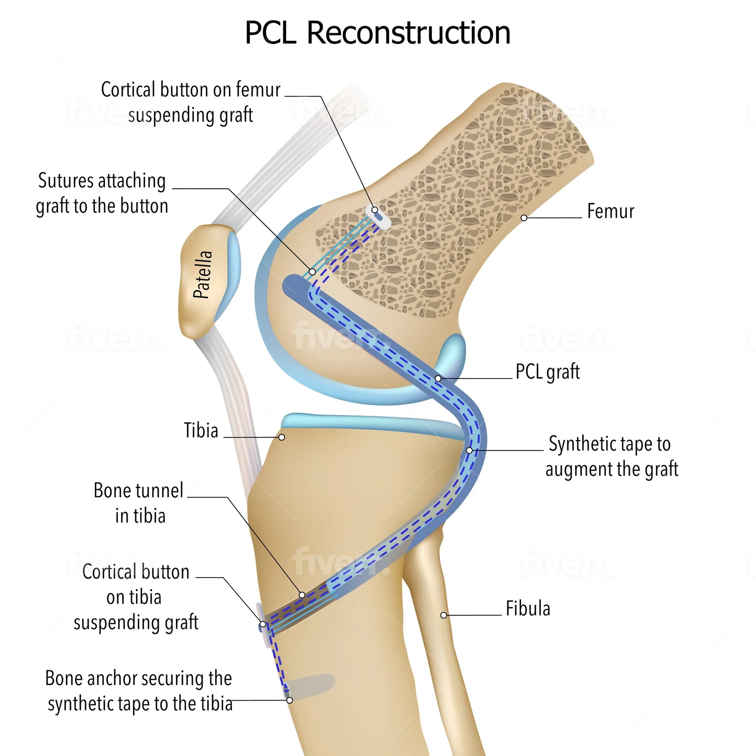 PCL Reconstruction | Posterior Cruciate Ligament