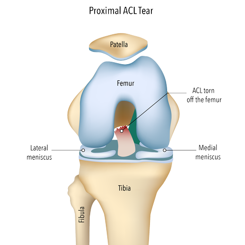 ACL Repair Surgery | ACL Rupture & ACL Tear Repair