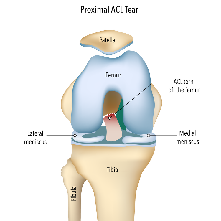 ACL Repair Surgery | ACL Rupture & ACL Tear Repair