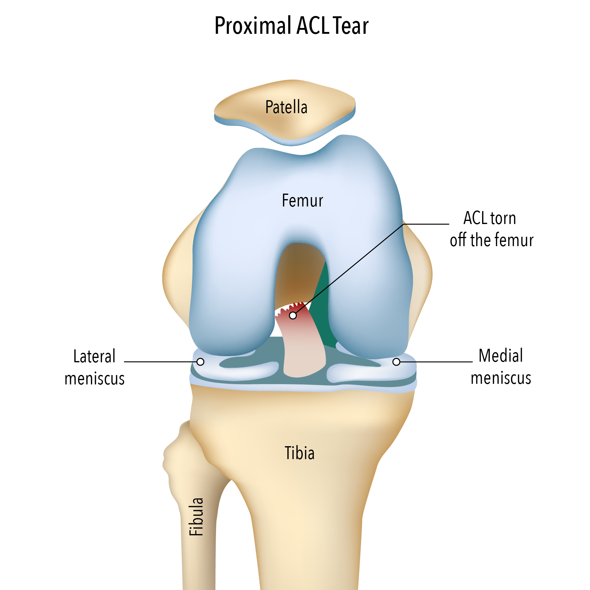 ACL Repair Surgery ACL Rupture ACL Tear Repair