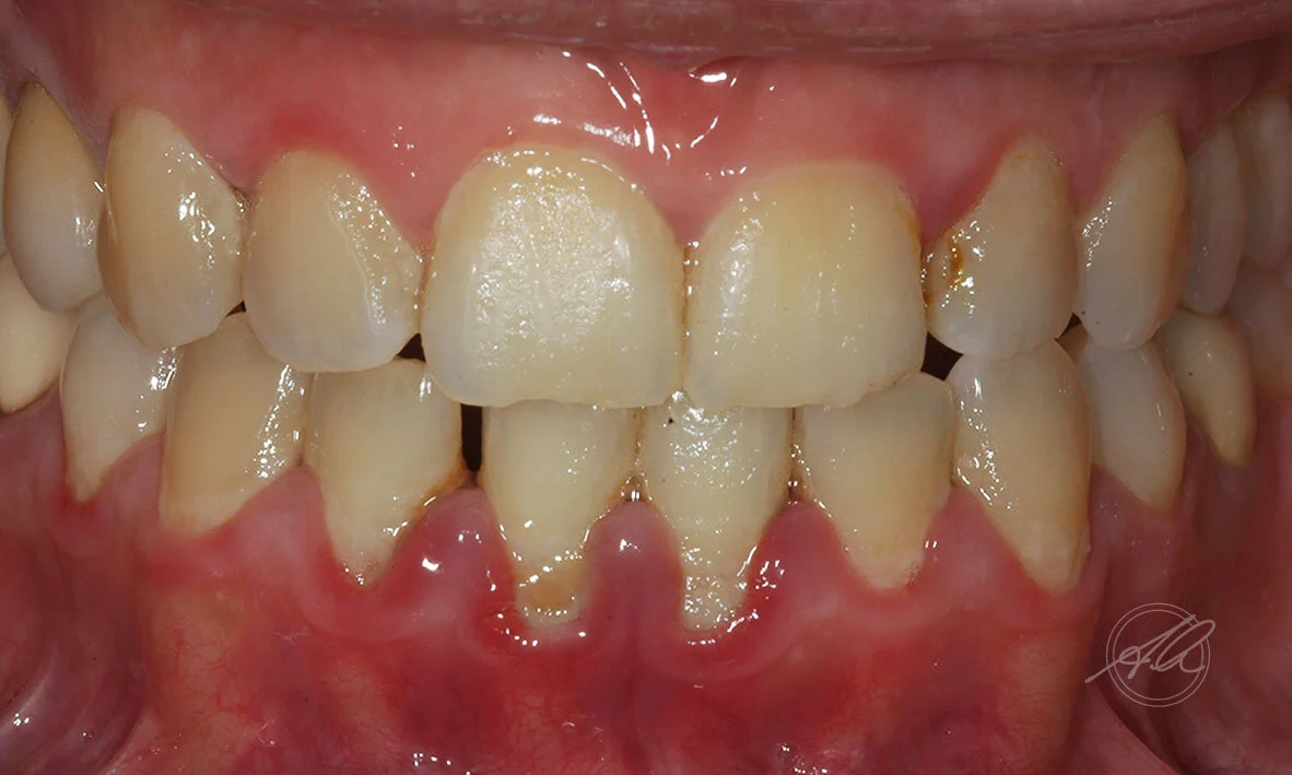 Periodontal Conditions we Treat | Periodontal Diseases — Smile ...