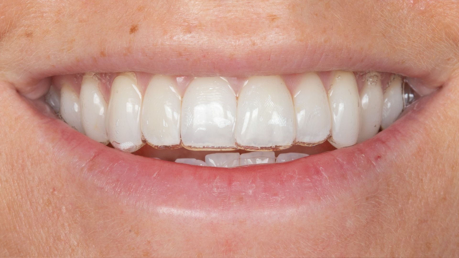 What is the cheapest way to fix crooked teeth? — S3 Dental Haywards Heath