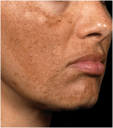 Fraxel Laser — Novel Skin Solutions
