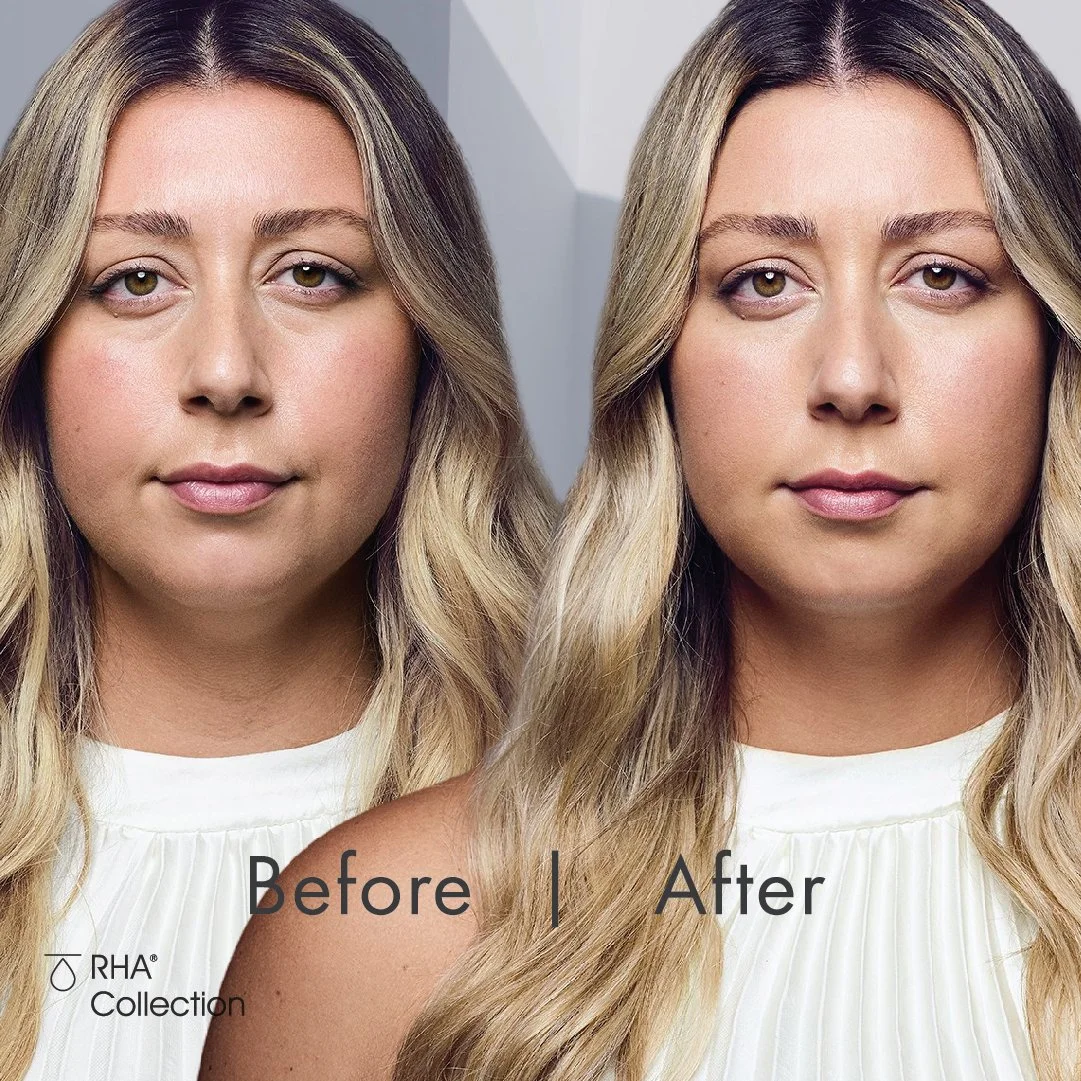 RHA Filler — Novel Skin Solutions