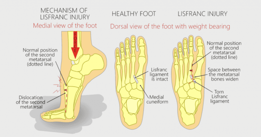 Physical Therapy for Lisfranc Injury [Infographic]-Mangiarelli ...