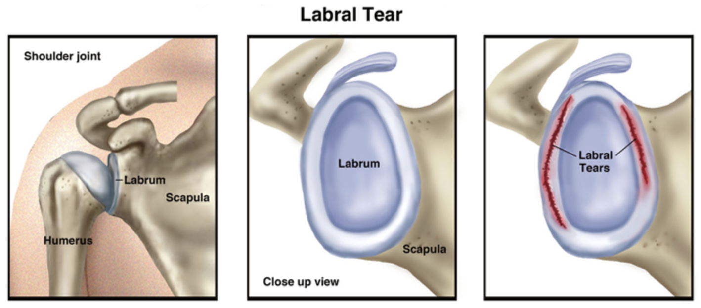 Labrum Injury labrum-injury