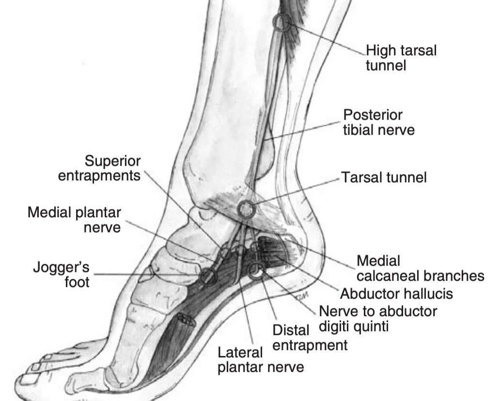 Physical Therapy for Tarsal Tunnel Syndrome-Mangiarelli Rehabilitation