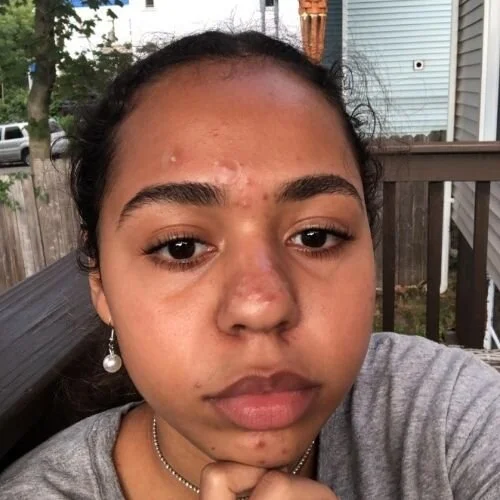 How to deal with the skin Purging Process! — self.skin