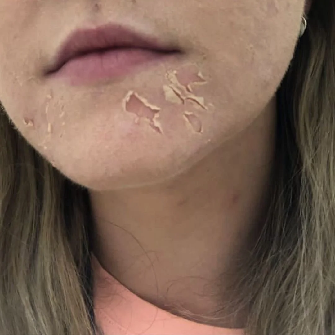 Should I get a Chemical Peel? — self.skin
