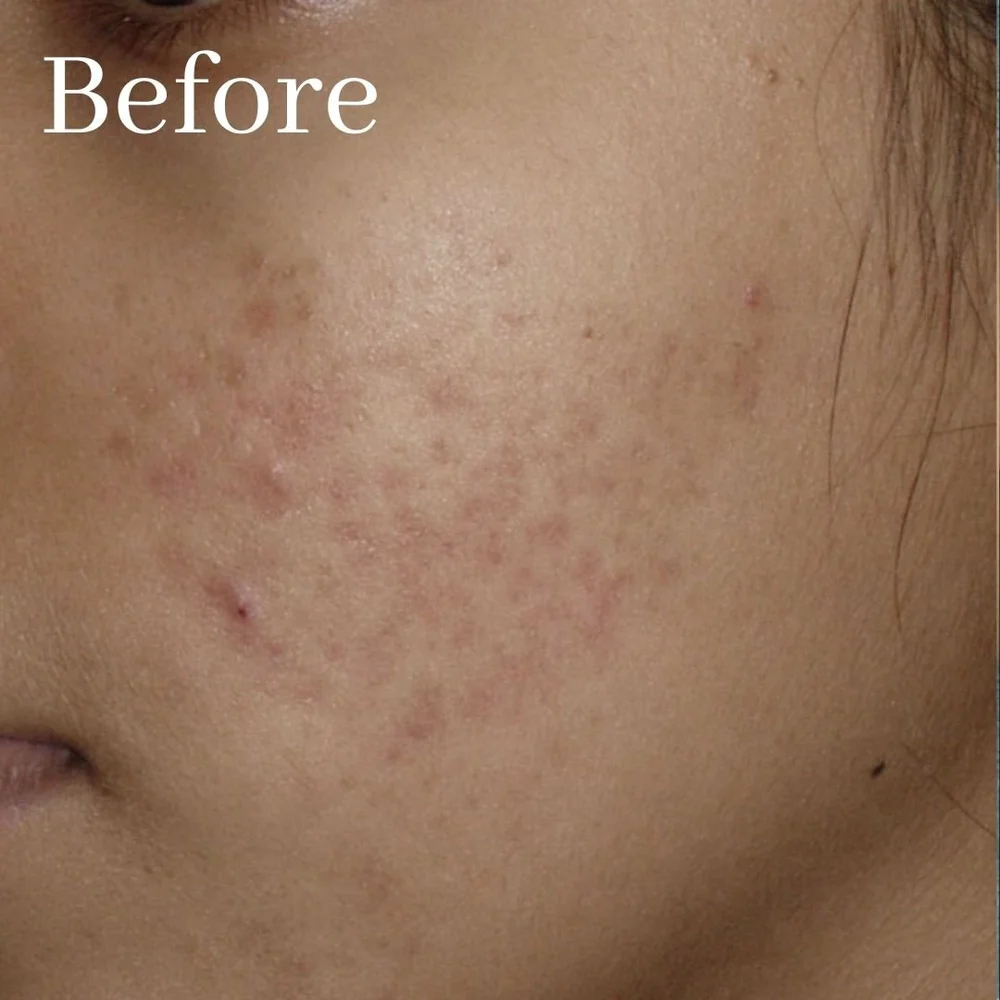 What is Micro-Needling and Do I Need It? — self.skin