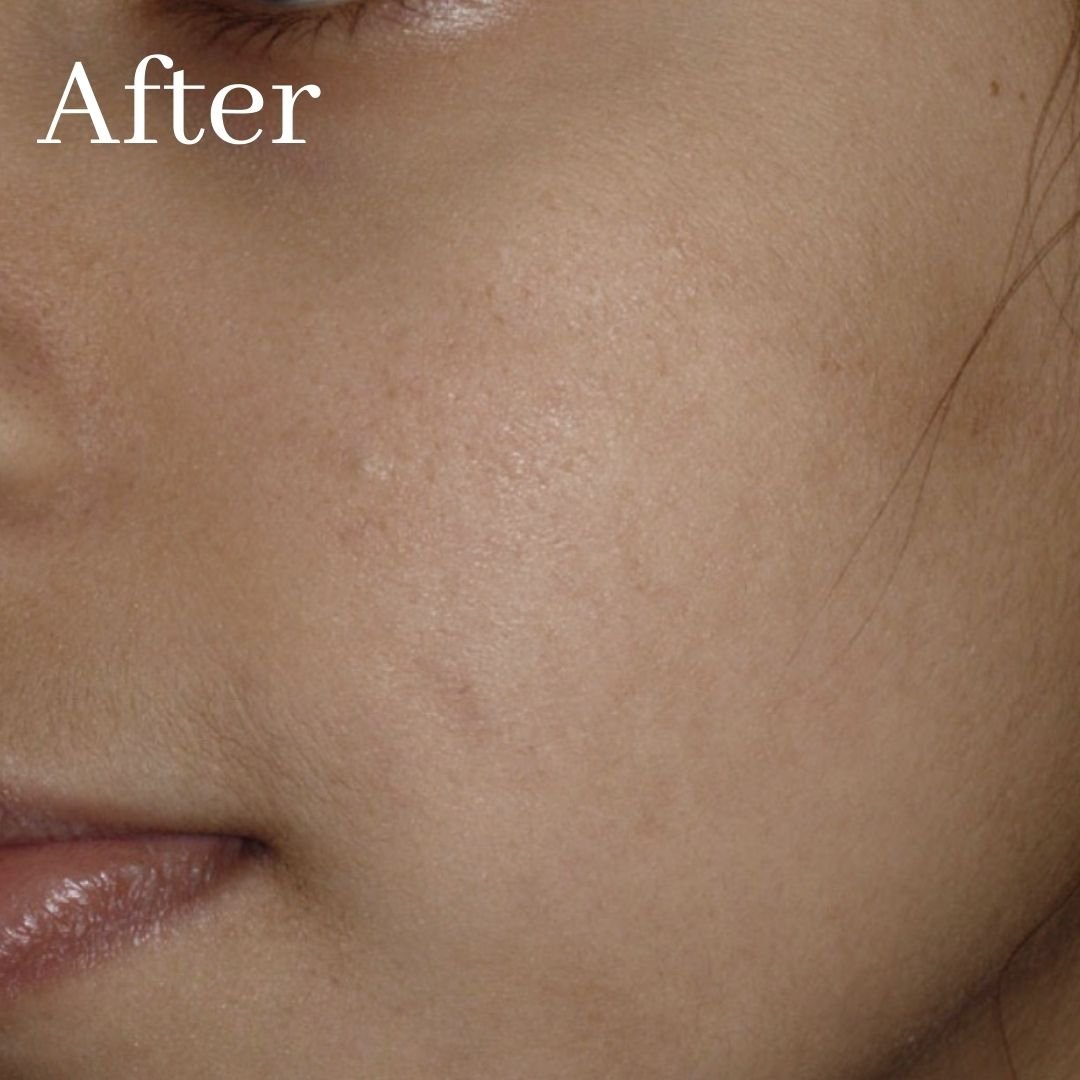 What is Micro-Needling and Do I Need It? — self.skin