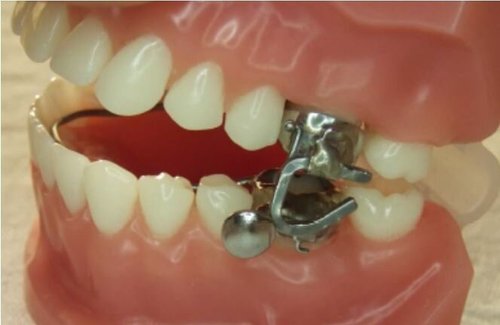 The MARA Appliance – Newport Medical Dental