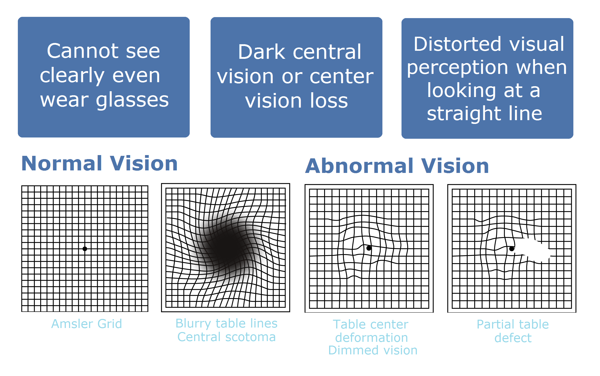 Macular Degeneration Vision Simulator