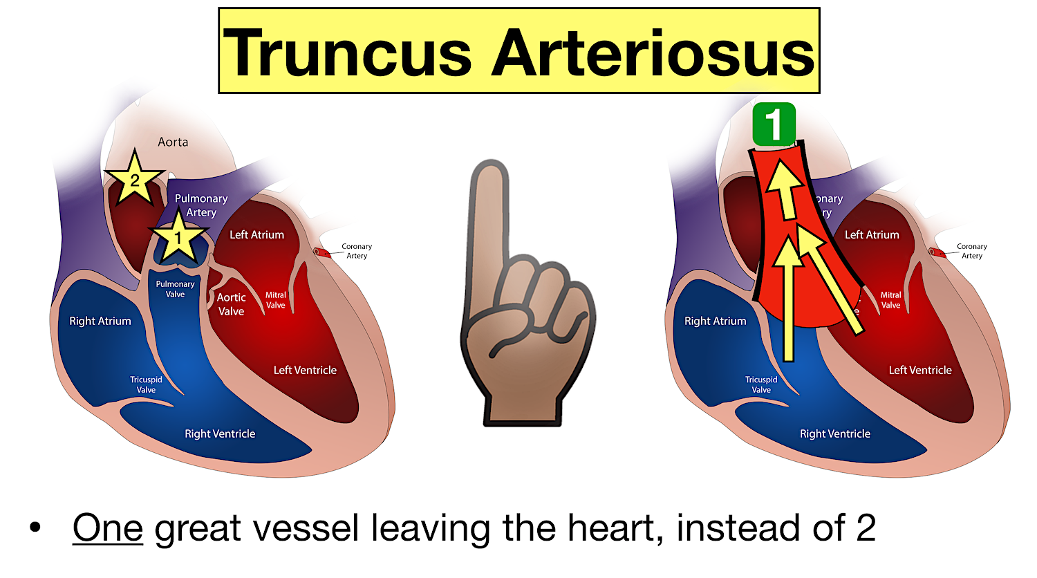 Congenital Heart Disease Symptoms Cyanotic Congenital Heart Defects