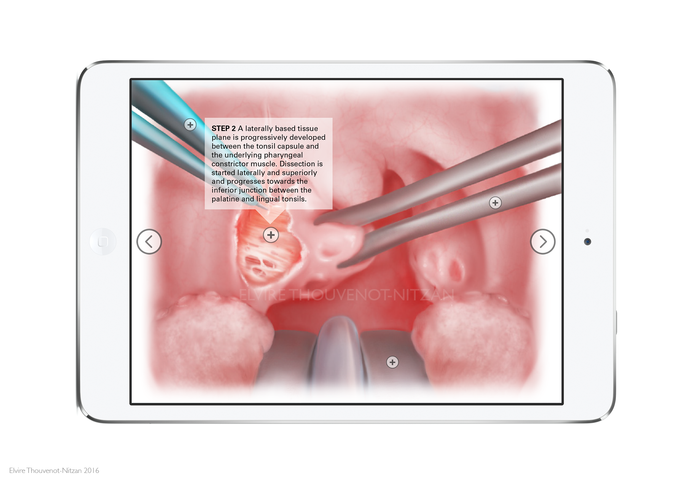Tonsillectomy - Illustrated Surgical Sequence — ELVIRE THOUVENOT