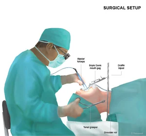 Tonsillectomy - Illustrated Surgical Sequence — ELVIRE THOUVENOT