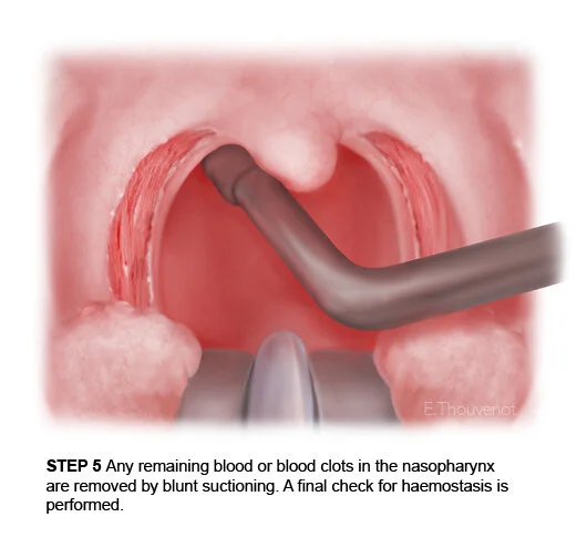 Tonsillectomy - Illustrated Surgical Sequence — ELVIRE THOUVENOT