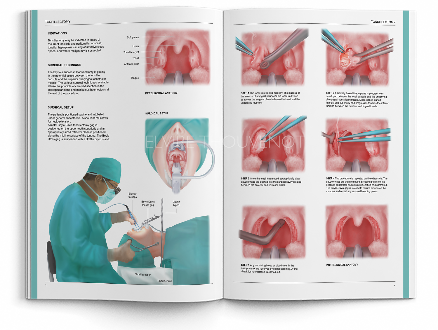 Tonsillectomy - Illustrated Surgical Sequence — ELVIRE THOUVENOT